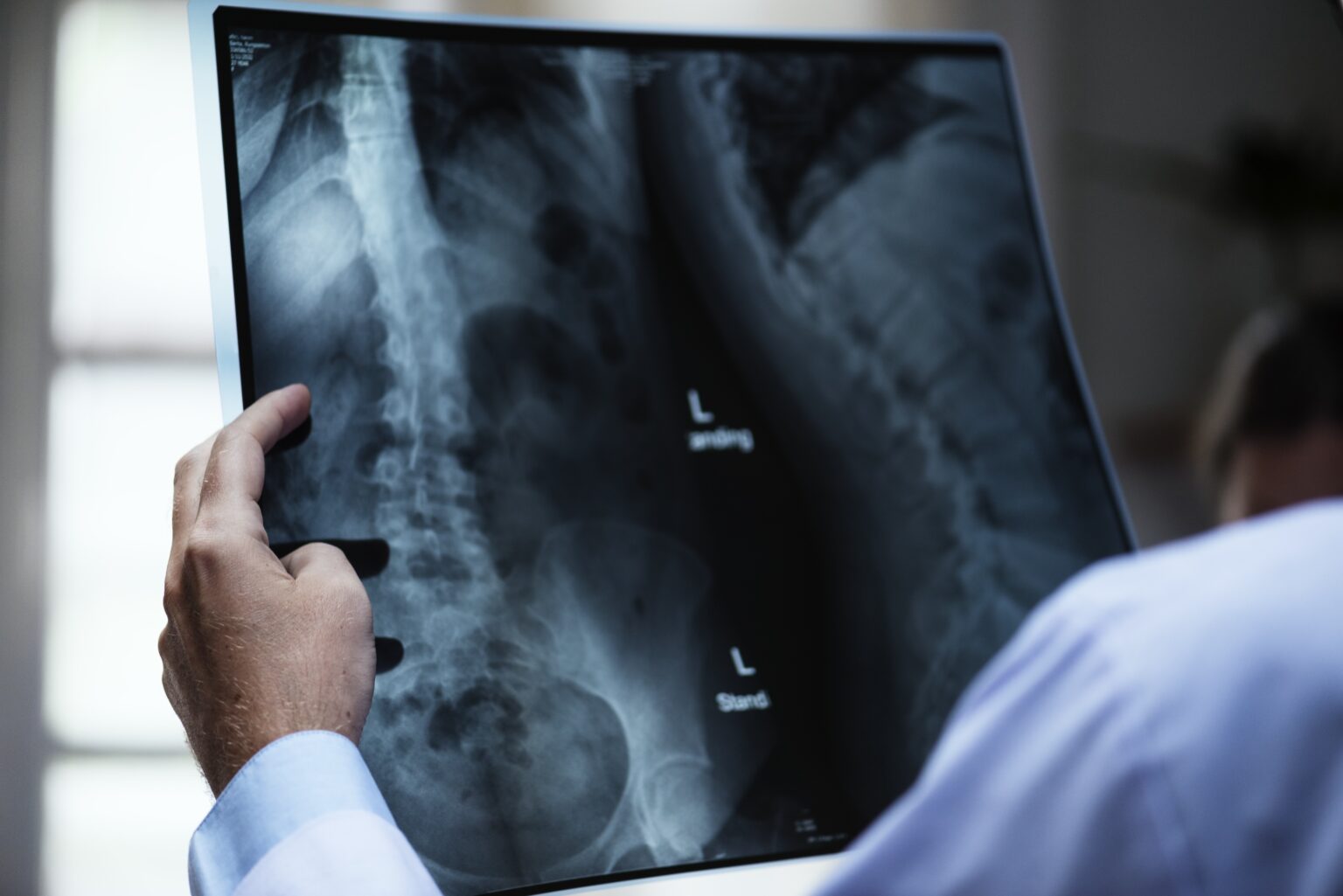 Sarcoma | Tipos, Síntomas, Causas y Tratamientos