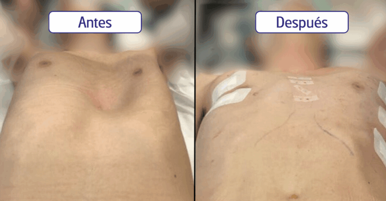 Pectus Excavatum en HM Hospitales | HM Nens